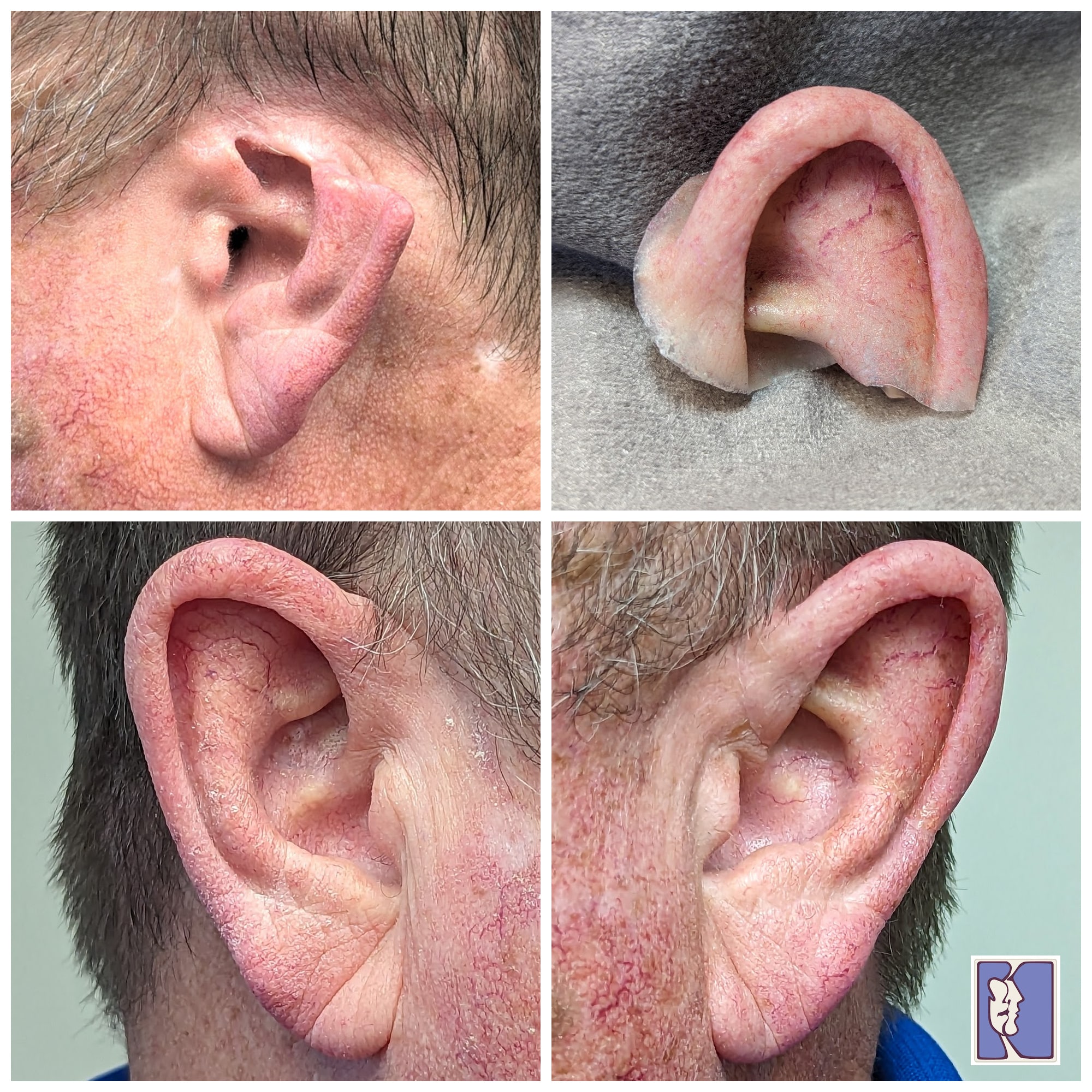 Upper Ear Prosthesis for our Kansas Veteran – The Medical Art ...